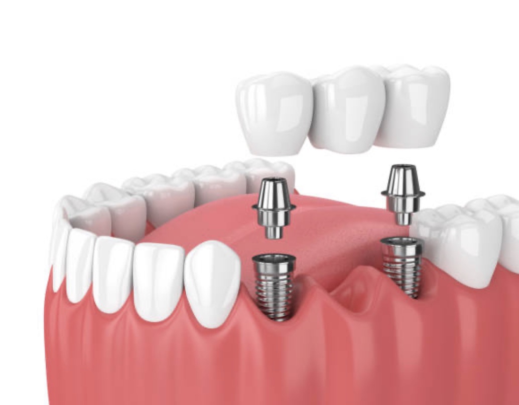 ΕΜΦΥΤΕΥΜΑΤΑ - Kakavas Dental Clinic - kakavasdentalclinic.gr